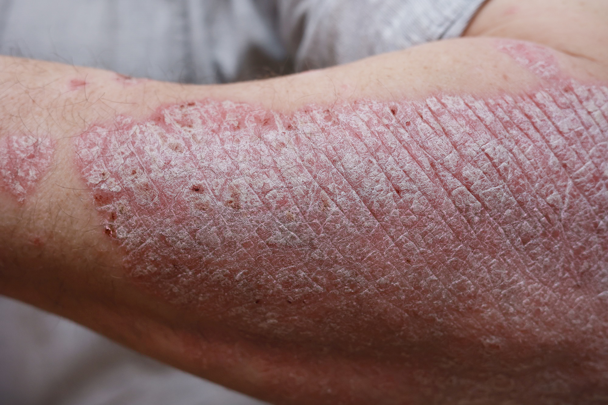 Eczema vs. Psoriasis: Understanding the Difference Between These Common ...