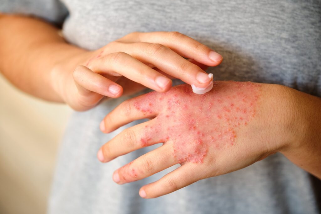 Eczema vs. Psoriasis: Understanding the Difference Between These Common ...